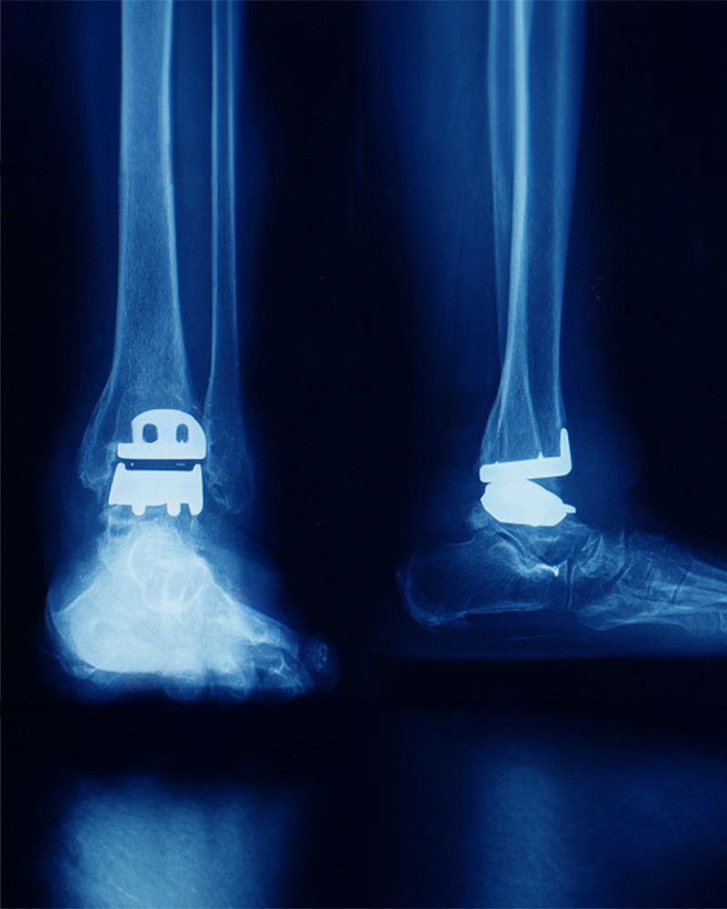 Ankle Replacement Surgery I Orthopaedics I St Vincents Private Hospitals